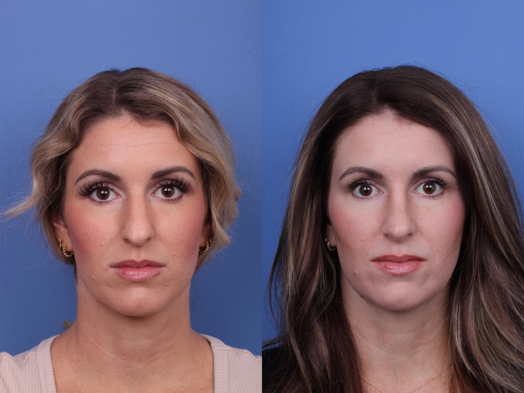 Rhinoplasty Before and After Pictures Case 624 | Scottsdale & Phoenix ...