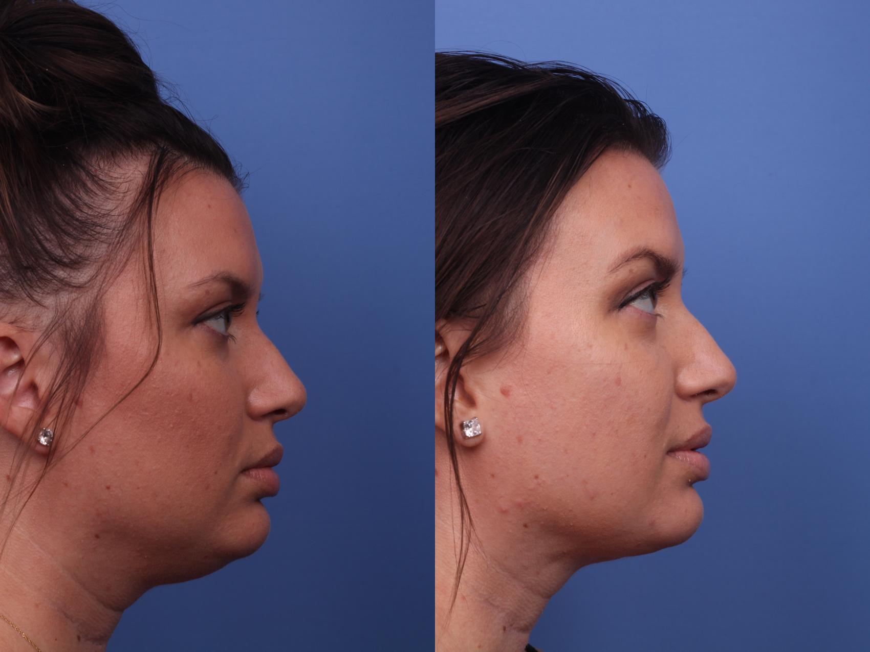 Submental Liposuction Before and After Pictures Case 446 | Scottsdale ...