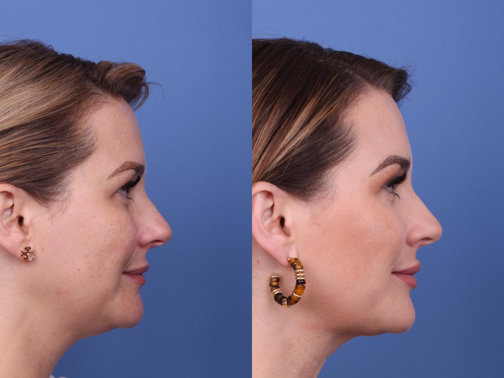 Submental Liposuction Before and After Pictures Case 545 | Scottsdale ...